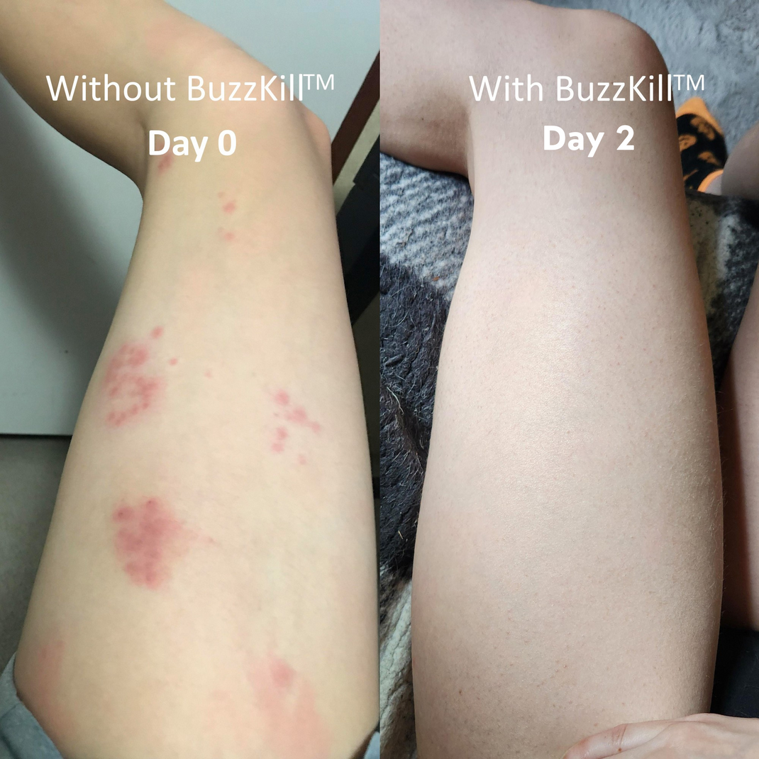 BuzzKill™ Non-Toxic Mosquito Repellant & Bite Healer – Buzz Kill