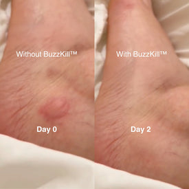 BuzzKill™ Non-Toxic Mosquito Repellant & Bite Healer – Buzz Kill